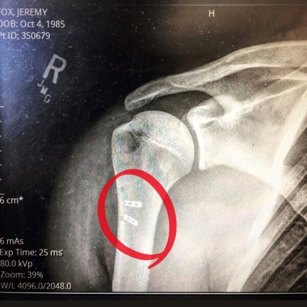 Torn Pectoral Muscle: Treatment, Recovery, Before & After Pictures